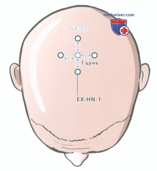 Точка EX-HN-1 си шэнь кун в акупунктуре